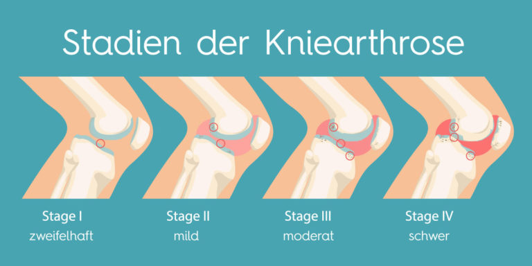 Diagnose Chondropathie: Frühzeitig gegensteuern ist der wichtigste Faktor